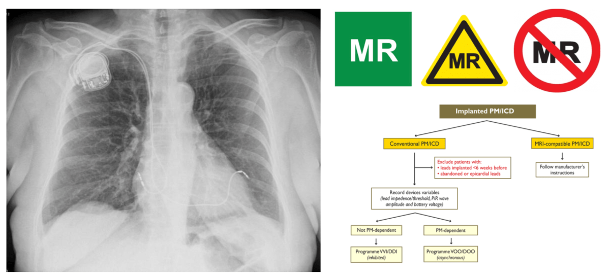 MRI for device patients study day – mrimypacemaker